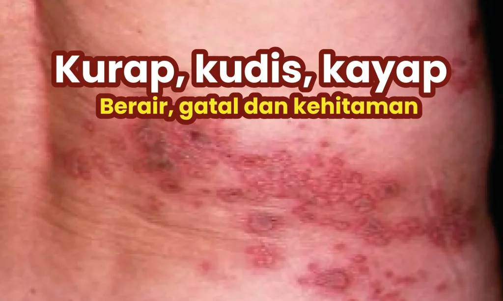 Orgaherbs HQ – #1 Penawar Masalah Kulit Organik